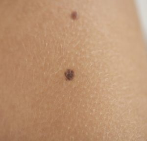 Grains de beauté – Dermalife